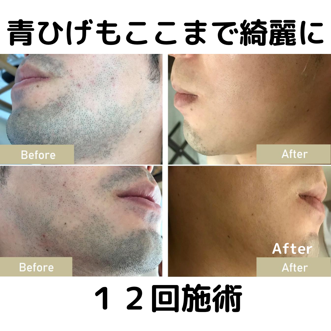 ヒゲ脱毛のビフォーアフター | ブログ | 豊橋市の最新LED脱毛ならSHINE Beauty Salon